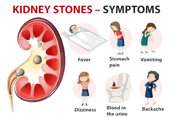 Kidney Stone Starting Symptoms: How to Recognize Early